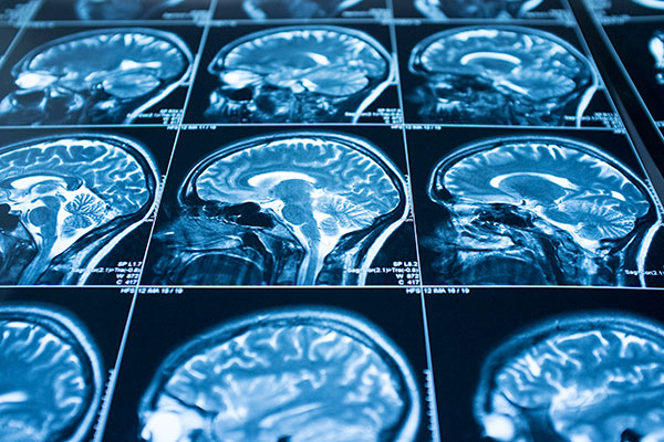 ADHD Brain Scan: How Brain Scans May Change the ADHD Diagnoses